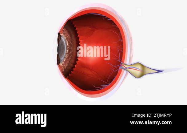 myopia, as it is medically termed, is a vision condition in which ...