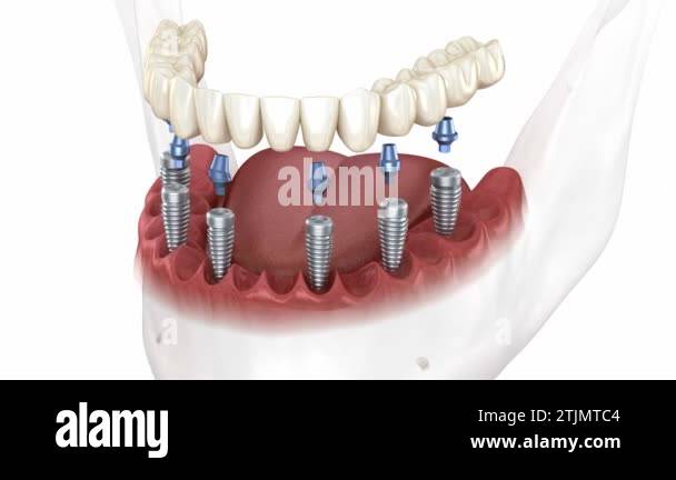 Removable mandibular prosthesis all on 6 system supported by implants ...