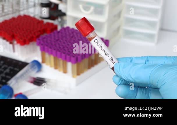 Cholesterol test to look for abnormalities from blood, blood sample to ...