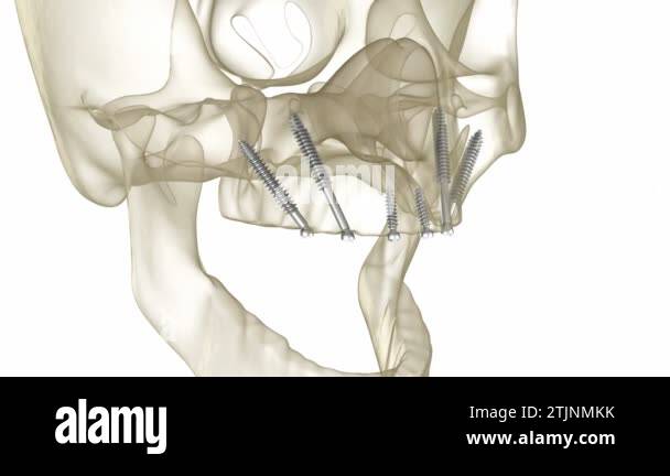 Maxillary prosthesis supported by zygomatic implants. Medically ...