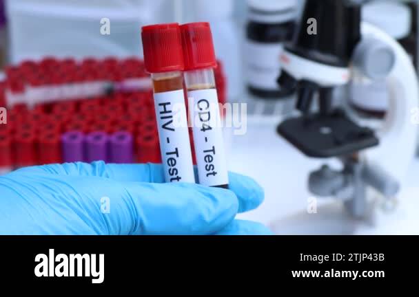 HIV test and CD4 test to look for abnormalities from blood, blood ...
