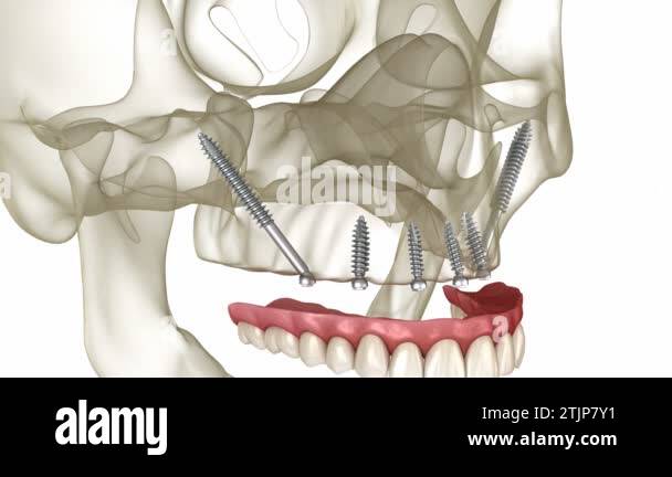 Maxillary and Mandibular prosthesis supported by zygomatic implants ...