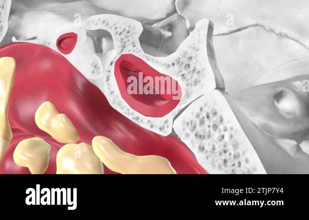 Sinusitis is an inflammation, or swelling, of the tissue lining your ...