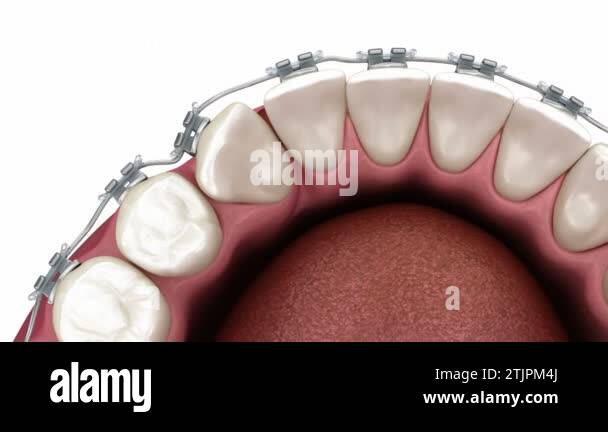 Cuspid tooth Stock Videos & Footage - HD and 4K Video Clips - Alamy