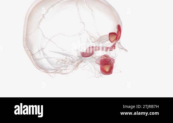 Sinusitis is an inflammation, or swelling, of the tissue lining your ...