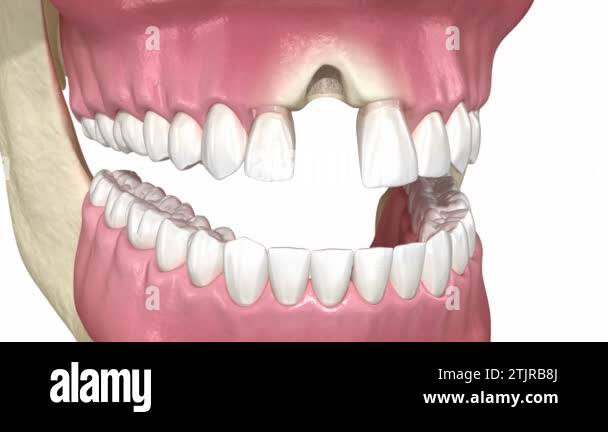 Bone grafting augmentation, socket preservation, tooth implantation ...