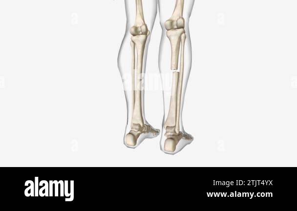 open fracture, also called a compound fracture, is a fracture in which ...