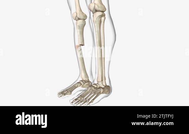 Compound bone fracture Stock Videos & Footage - HD and 4K Video Clips ...