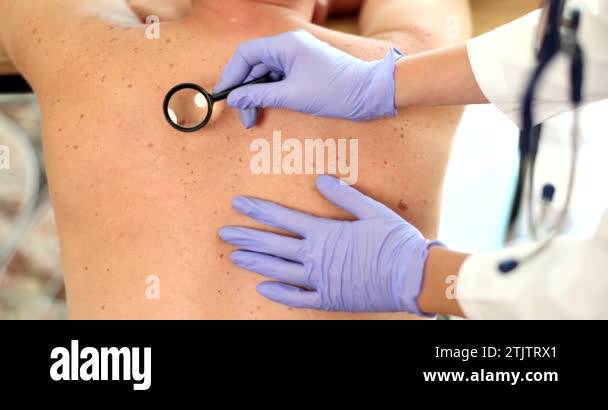 Moles on back skin cancer Stock Videos & Footage - HD and 4K Video ...