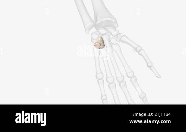 Hamate fracture Stock Videos & Footage - HD and 4K Video Clips - Alamy