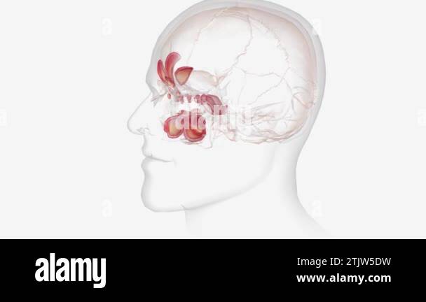 Sinusitis is an inflammation, or swelling, of the tissue lining your ...