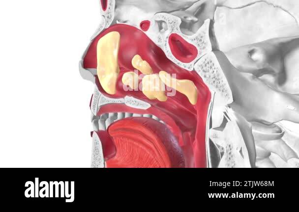 Sinusitis is an inflammation, or swelling, of the tissue lining your ...