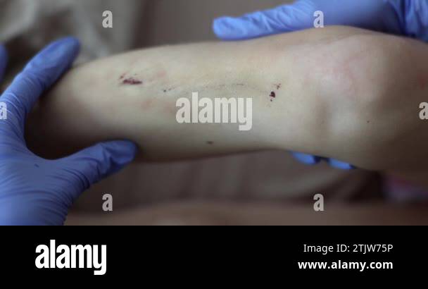 Doctor conducts medical examination of child leg with scratches and ...