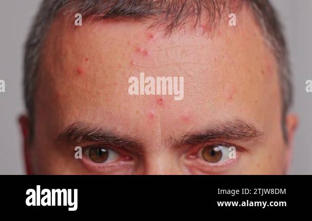 Man's forehead with acne, red spots, skin disease. Varicella or Herpes Zoster concept Stock ...