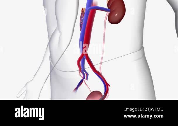 Kidney stones (also called renal calculi, nephrolithiasis or ...