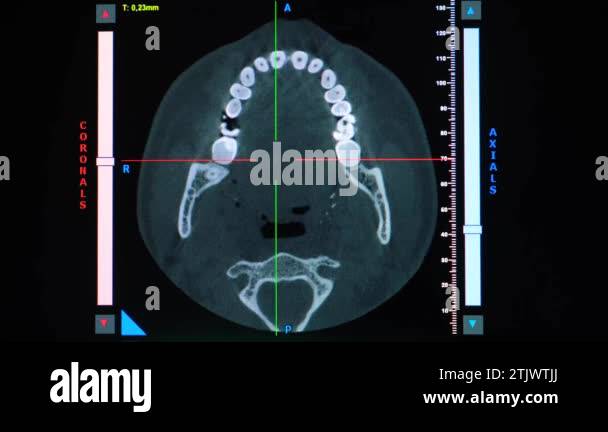 CT scan of a patient with malocclusion, missing chewing tooth and ...