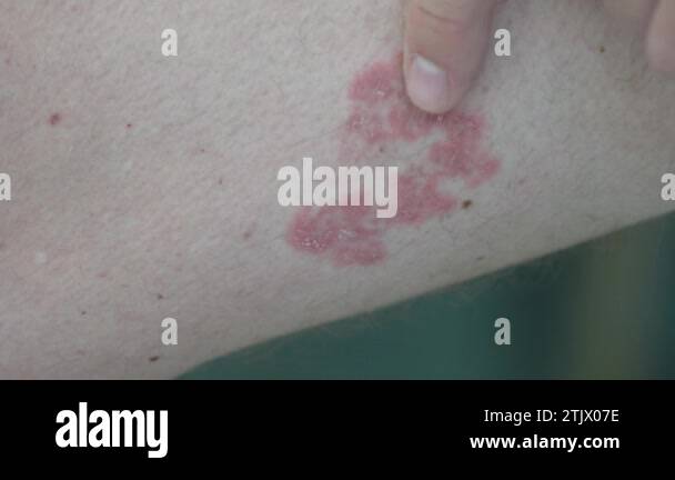 Shingles rash on hand Stock Videos & Footage - HD and 4K Video Clips ...