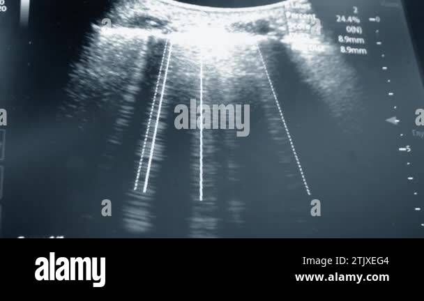 Ultrasound on monitor. Ultrasound image on computer monitor screen ...