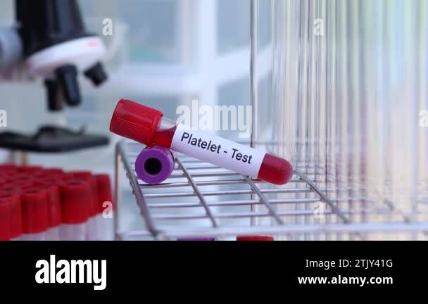 platelet test to look for abnormalities from blood, blood sample to ...