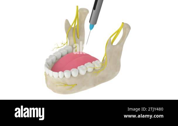 Mandibular arch with incisive nerve block. Types of dental anesthesia ...