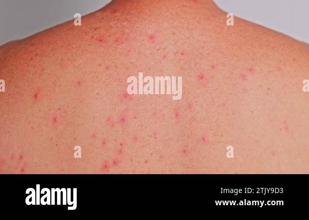 Man's back with acne, red spots, skin disease. Varicella or Herpes ...
