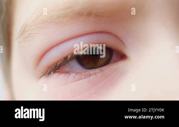 Eye of a 5-year-old child with conjunctivitis, inflammation of the ...