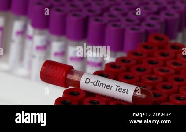 D-dimer test to look for abnormalities from blood, blood sample to ...