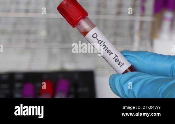D-dimer test to look for abnormalities from blood, blood sample to ...
