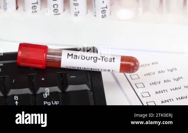 Marburg test to look for abnormalities from blood, blood sample to ...
