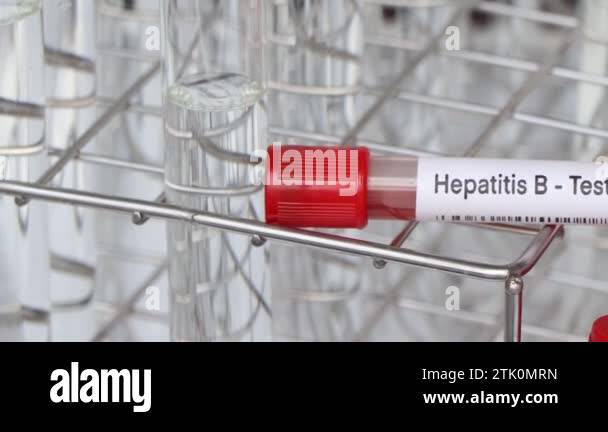Hepatitis B test to look for abnormalities from blood, blood sample to ...