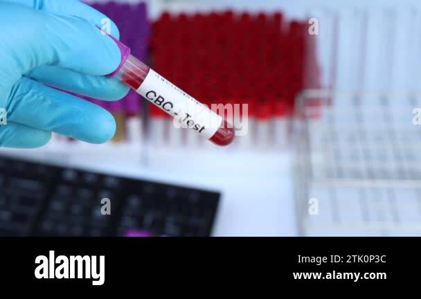 CBC test to look for abnormalities from blood, blood sample to analyze ...