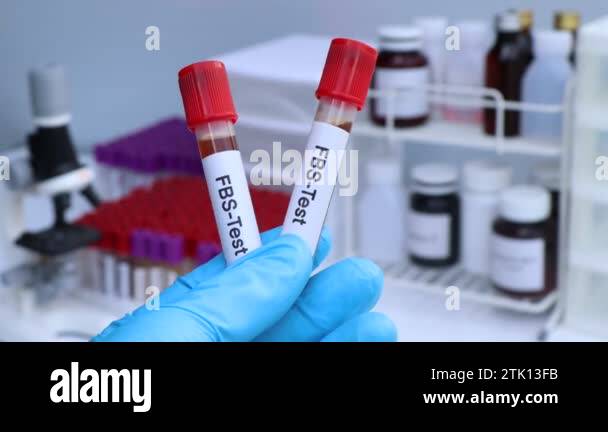 FBS test to look for abnormalities from blood, blood sample to analyze ...