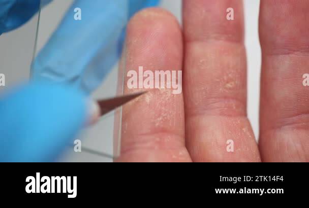 Dermatologist takes scraping from problematic skin of patients hands ...