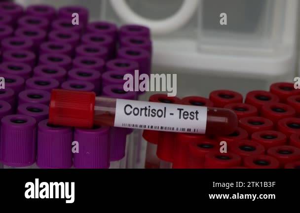Cortisol test to look for abnormalities from blood, blood sample to ...