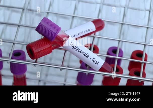 Triglyceride test to look for abnormalities from blood, blood sample to ...