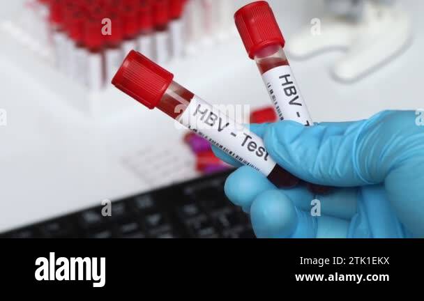 HBV Test to look for abnormalities from blood, blood sample to analyze ...
