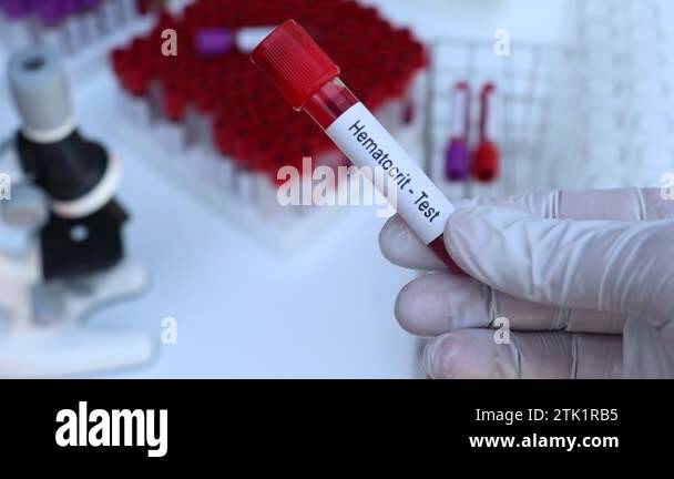 Hematocrit test to look for abnormalities from blood, blood sample to ...