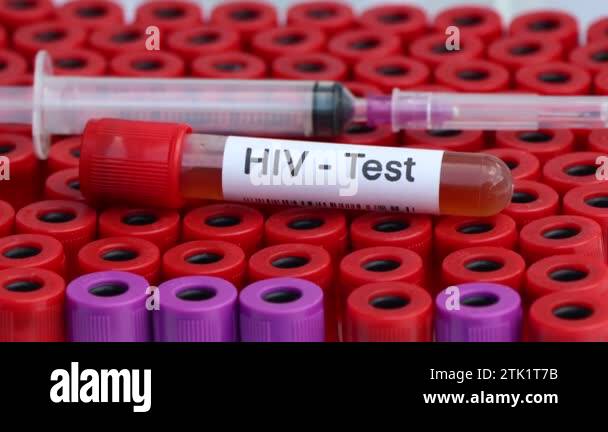 HIV test to look for abnormalities from blood, blood sample to analyze ...