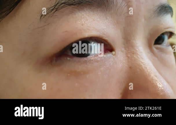 Eye mucus Stock Videos & Footage - HD and 4K Video Clips - Alamy