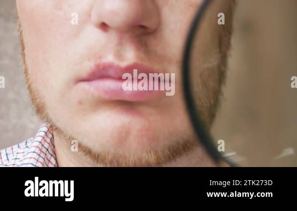 Close-up Herpes on the lip of a man through a magnifying glass, pimple ...