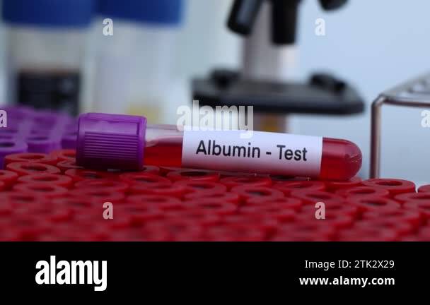 Albumin test to look for abnormalities from blood, blood sample to ...