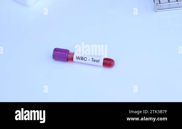 WBC test to look for abnormalities from blood, blood sample to analyze ...