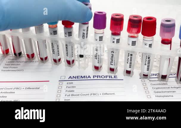 Blood drawn sample from a patient for analysis of anemia. Hand doctor ...