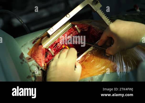 Surgical Stock Videos & Footage - HD and 4K Video Clips - Alamy