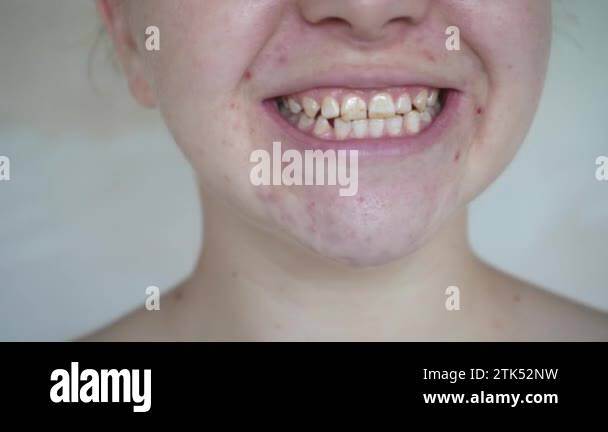 Fluorosis Teeth Stock Videos And Footage Hd And 4k Video Clips Alamy 7450