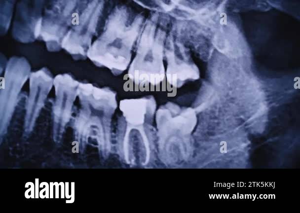 X-ray image of the jaw of all human teeth close-up. Magnetic resonance ...