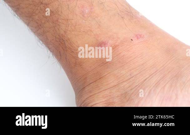 wound on skin caused by Scratch Allergic skin from mosquito or insect ...