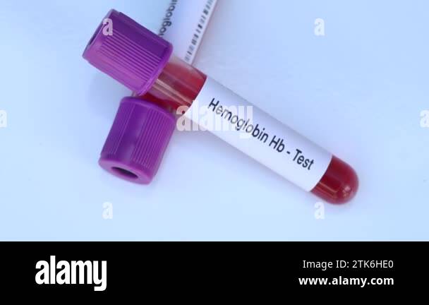 hemoglobin hb test to look for abnormalities from blood, blood sample ...