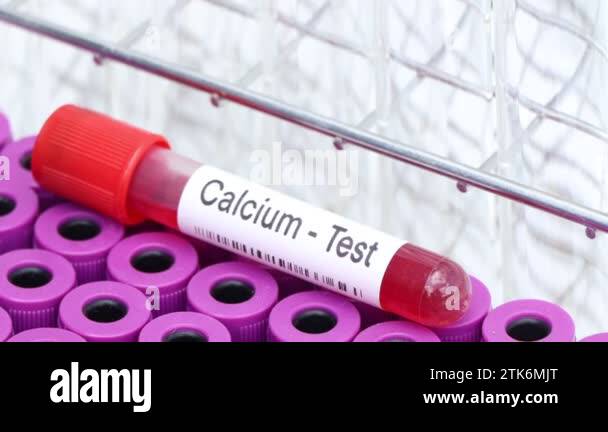 calcium test to look for abnormalities from blood, blood sample to ...