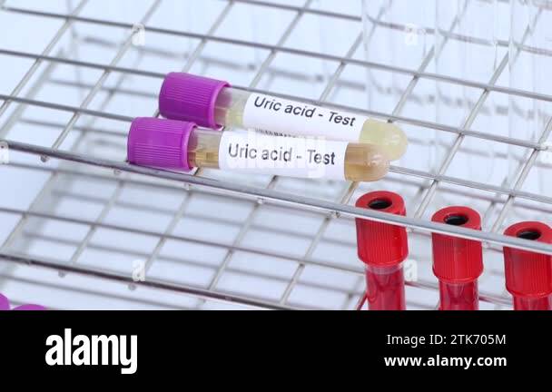 Uric acid test to look for abnormalities from Urine, Urine sample to ...